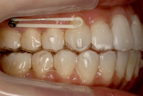 Mini-implantes no tratamento com Invisalign: o que são e por que são ...