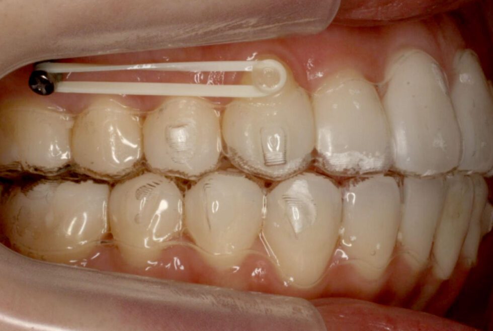 Mini-implantes no tratamento com Invisalign: o que são e por que são ...