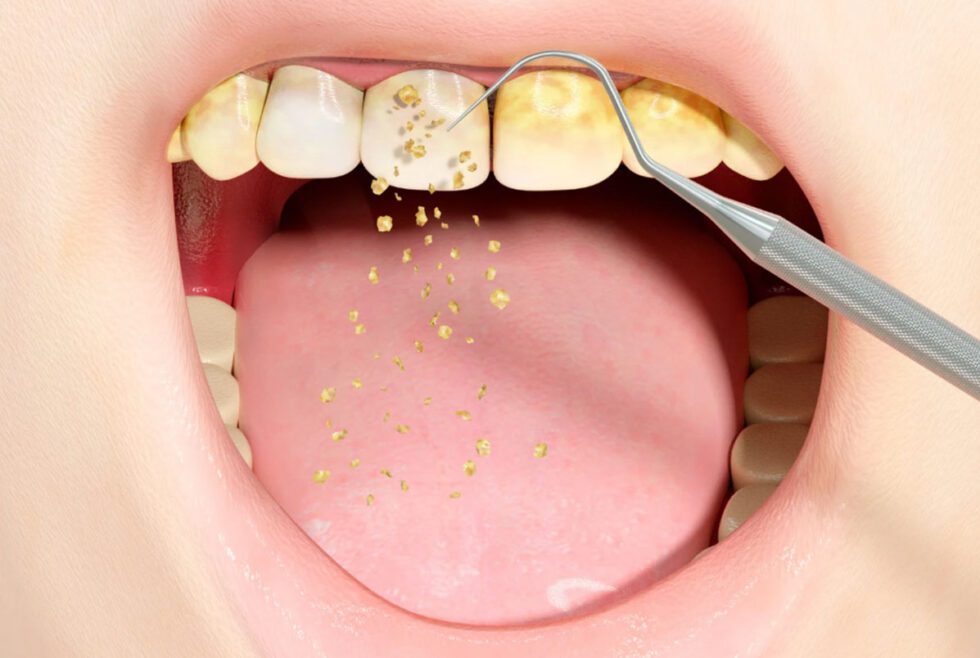 O que é tártaro, como se forma e como cuidar? - Kátia Rie Odontologia