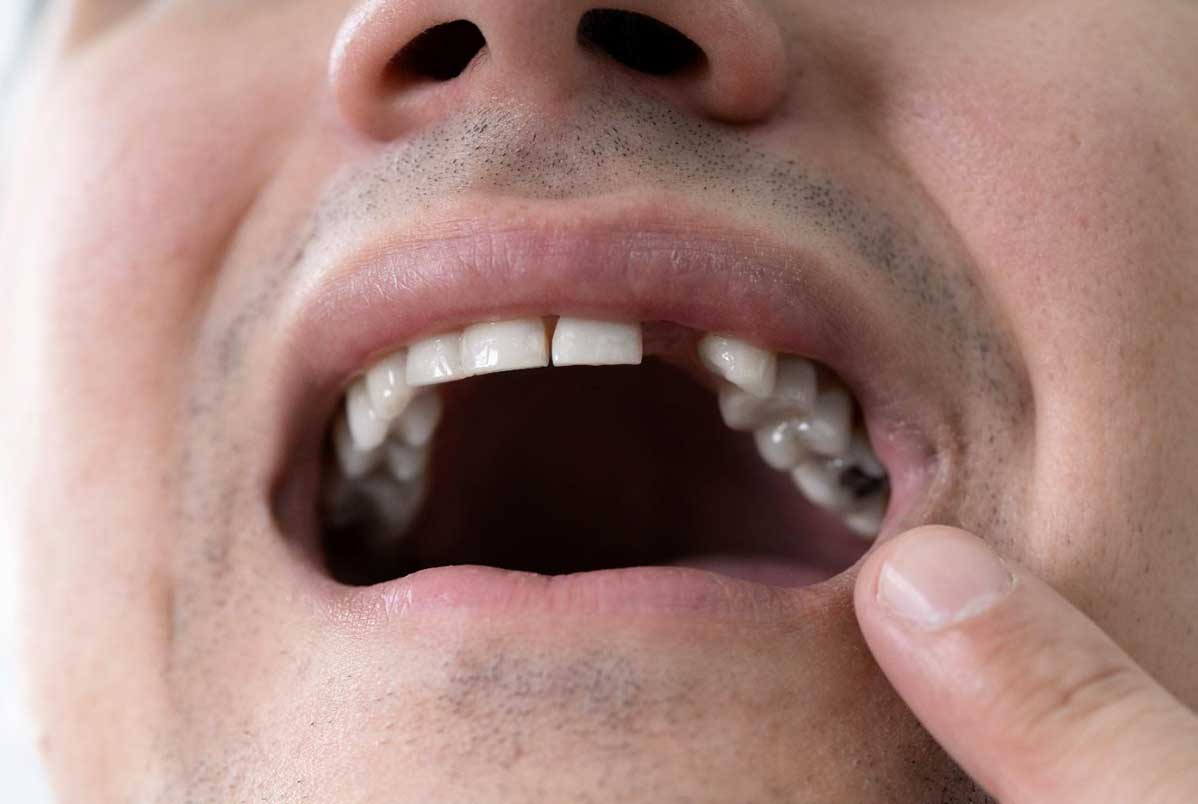 O que é um pôntico e como ele pode ser usado em tratamentos com ...