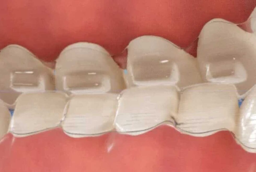 O que são bite ramps no tratamento Invisalign? - Kátia Rie Odontologia