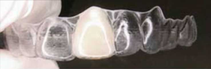 O que é um pôntico e como ele pode ser usado em tratamentos com ...