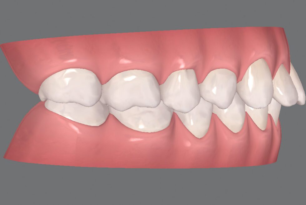 Tenho Classe II. Posso usar Invisalign? - Kátia Rie Odontologia